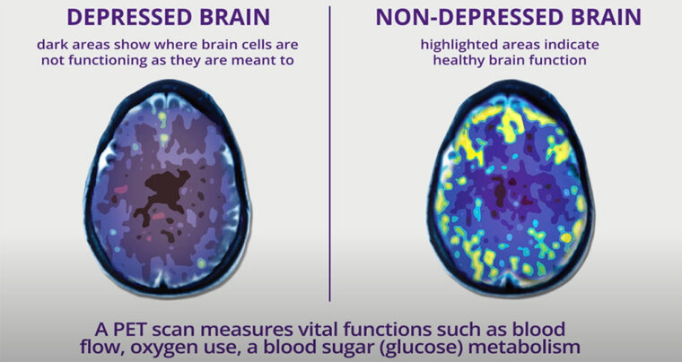 NeuroStar TMS Therapy Offers Hope For Depression Treatment